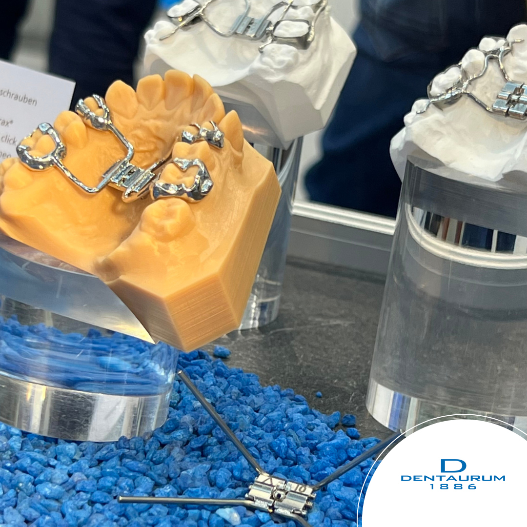 Dentaurum RPE Screws: Reliable, Safe Palatal Expansion with a Proven System