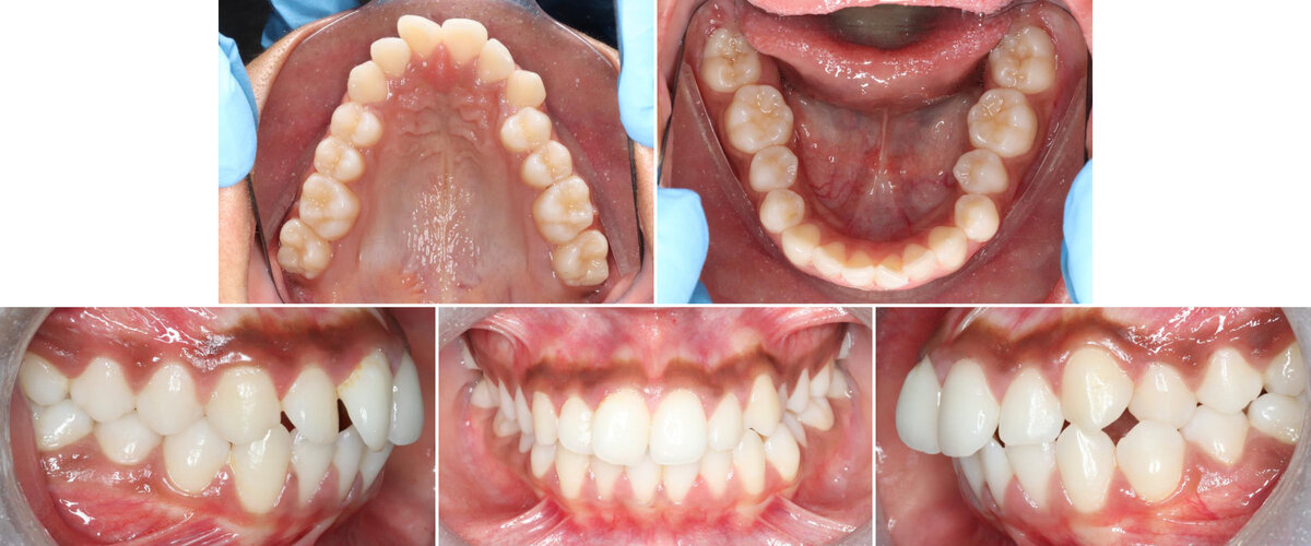 Palatal expansion using the MARPE appliance: Macono Orthodontic and ...