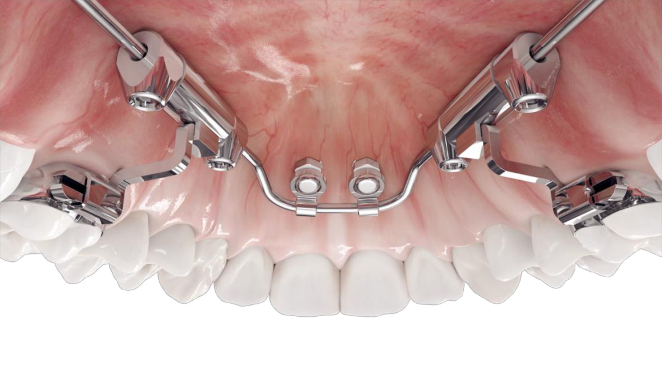 amda®. The advanced molar distalization appliance.